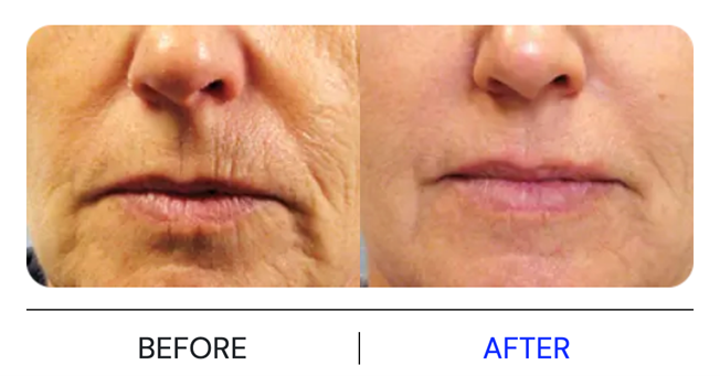Tixel® Skin Resurfacing in the Woodlands, Texas